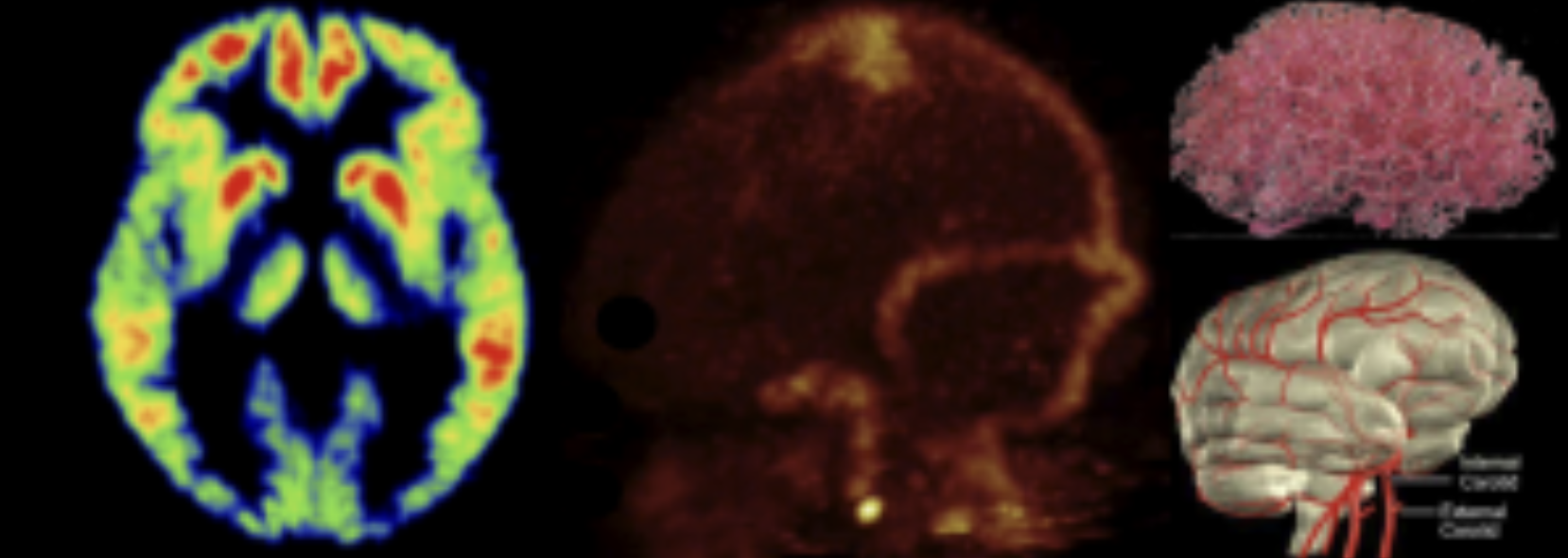 Past Study: Non-invasive quantification of Positron Emission Tomography ...