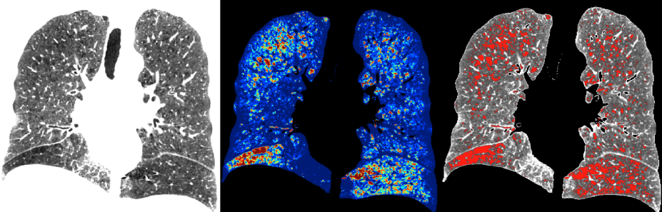 Adaptive quantification and subtyping of pulmonary emphysema from CT ...
