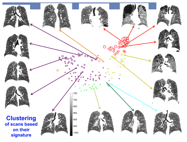 Adaptive quantification and subtyping of pulmonary emphysema from CT ...